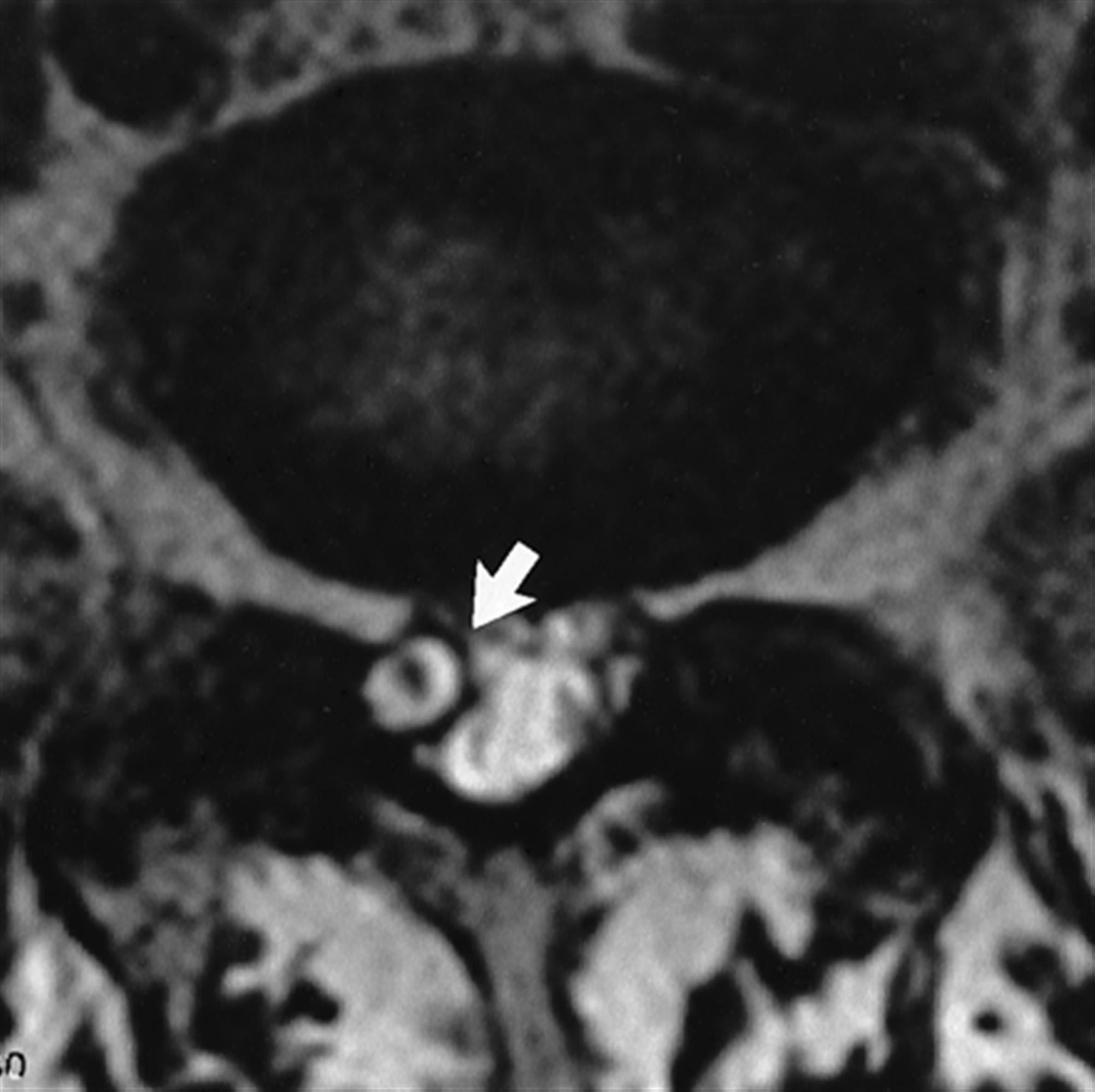 Synovial Facet Cyst Spine Orthobullets Synovial Facet Cyst Spine Orthobullets